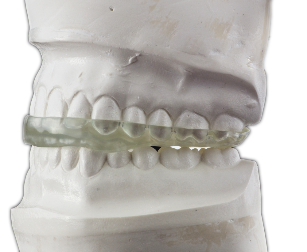 Occlusal Splints Hanham Dental Laboratory Occlusal Splints Hanham Dental Laboratory